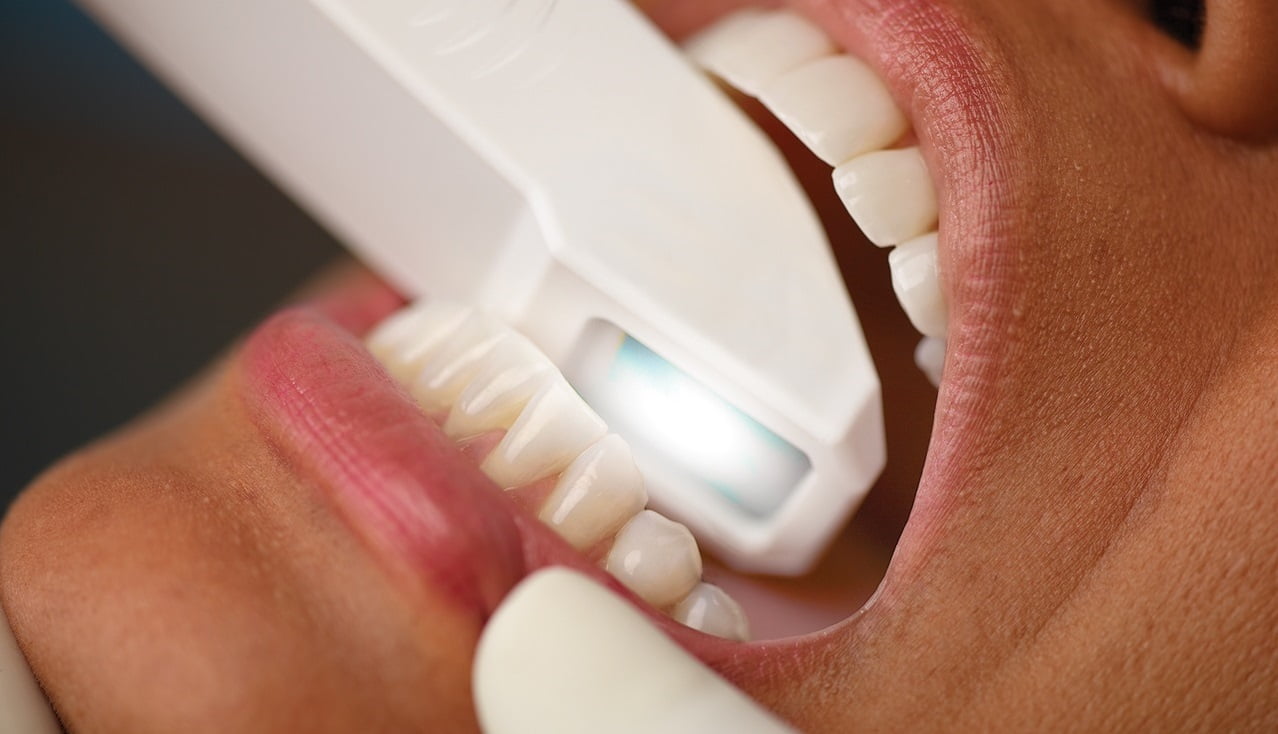 Invisalign Leicester - Invisalign Near Me - Wigston